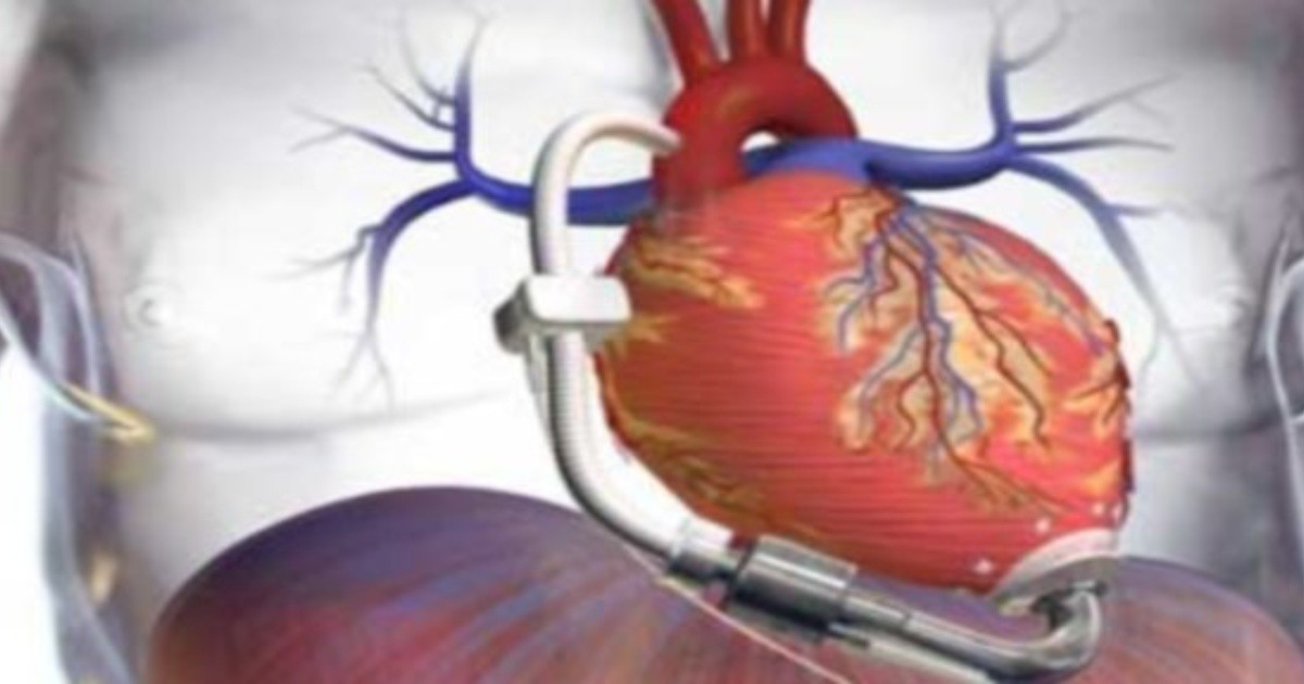 Implantan el primer mini corazón artificial | Rosario3