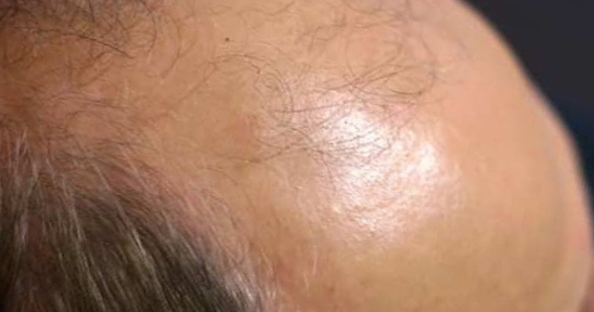 Un compuesto podría ser capaz de hacer crecer pelo en zonas calvas de ...