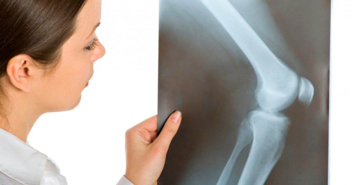 ¿Qué es la osteopetrosis? | Rosario3