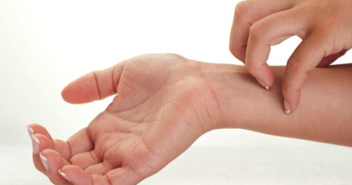 Urticaria crónica: ronchas y picazón en la piel | Rosario3