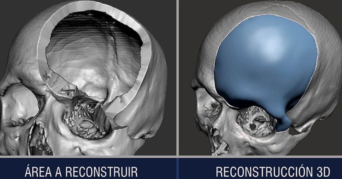 Cirugía virtual y reconstrucción 3D de cráneo asistida por ...