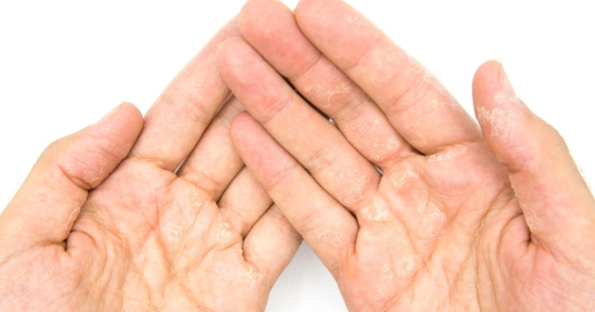 ¿Manos resecas? Cómo cuidarlas en simples pasos | Rosario3