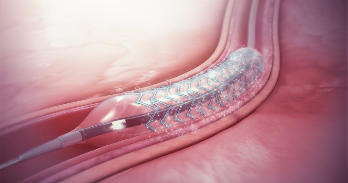 El stent, el invento de un médico argentino | Rosario3
