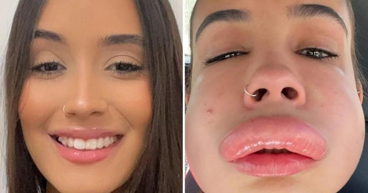 Se puso relleno en los labios y tuvo una reacción que le dejó la cara ...